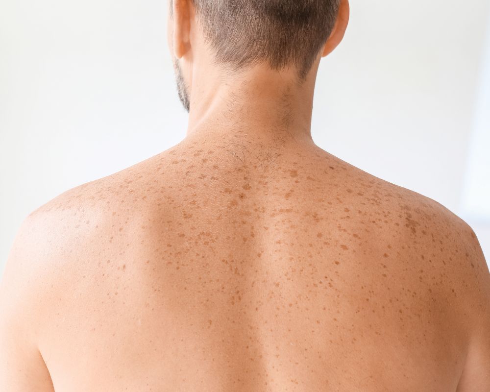 Macchie solari sulla pelle, come prevenirle ed eliminarle: i consigli ...